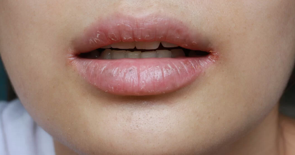 Queilitis o boceras: tratamiento | Vídeos MedicinaTV